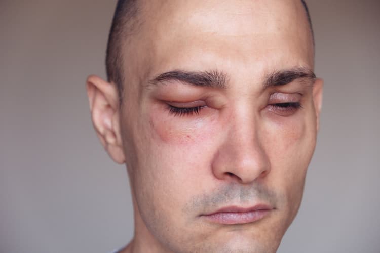 Hereditäres Angioödem (HAE): „Die Diagnose war eine enorme Erleichterung!“