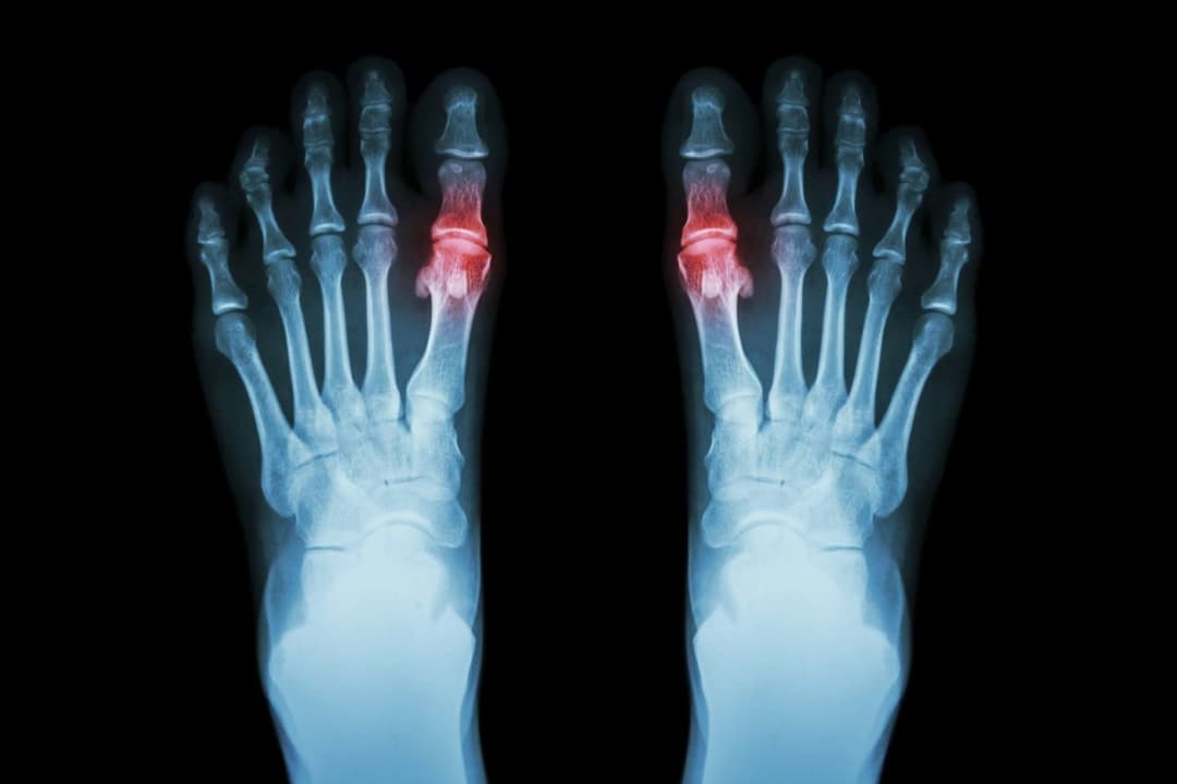Leitlinie zu Bildgebung bei Gicht und anderen Kristallarthropathien